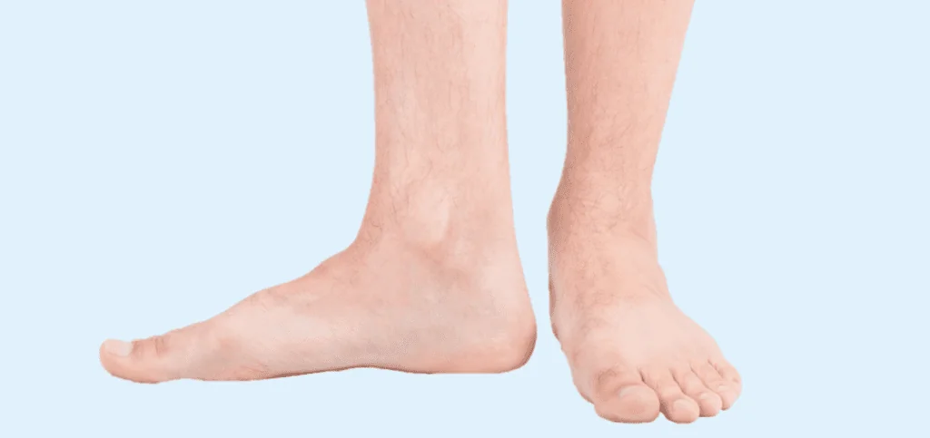 Flat foot or cavus foot: which one do you have? | PiedRéseau