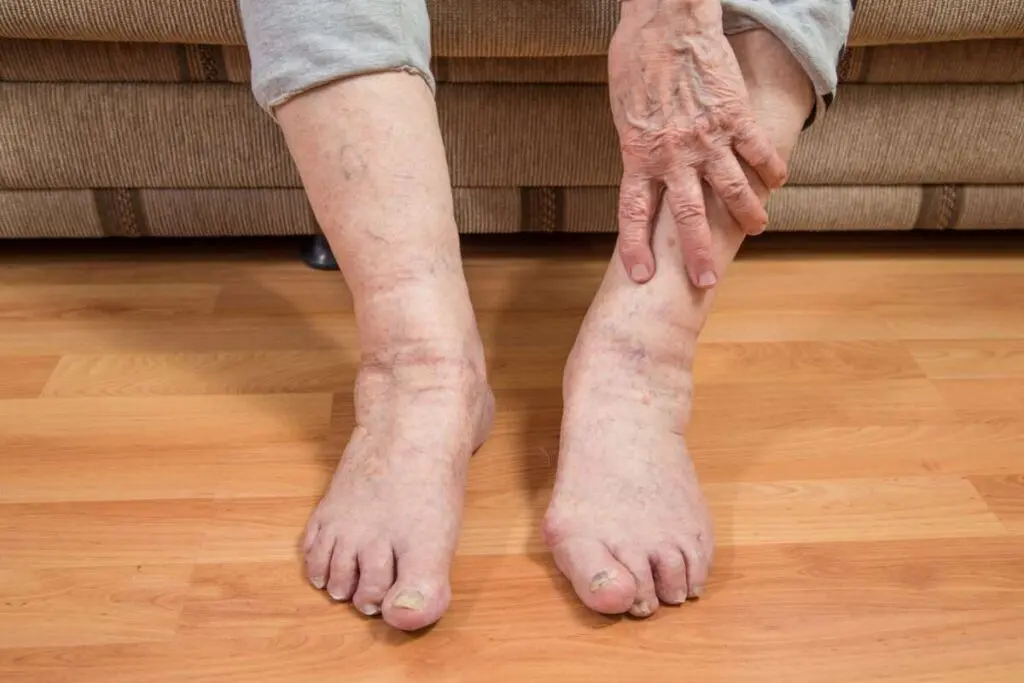 Foot deformities : symptoms and treatments | PiedRéseau