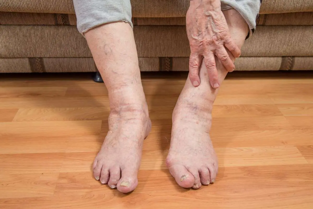 Foot deformities : symptoms and treatments | PiedRéseau