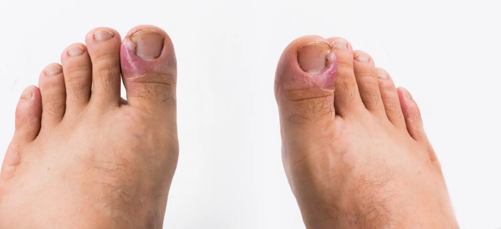 Treatments for paronychia of the toe | PiedRéseau