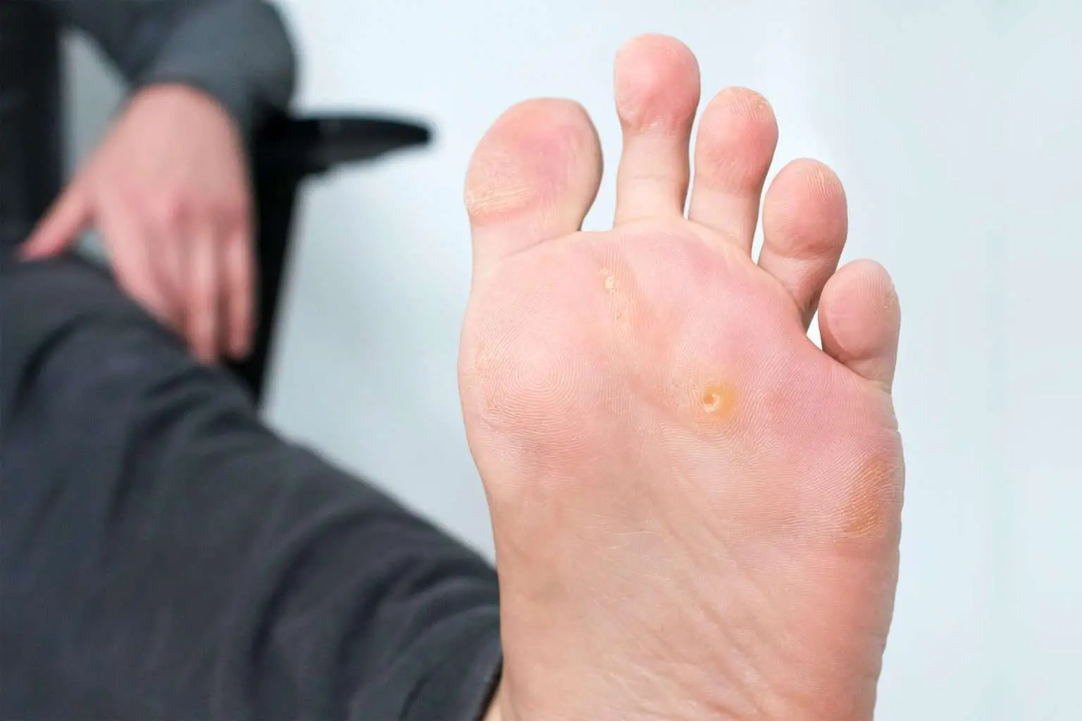 How to remove and avoid foot corns | PiedRéseau